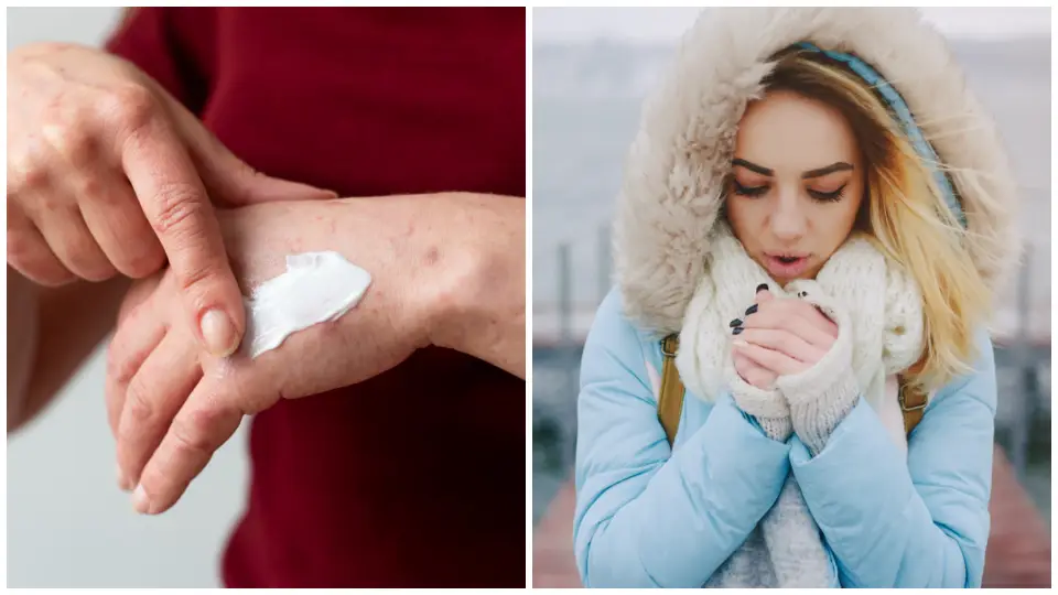 Certifikovaná dermatologička radí: Máte v zime stále suché ruky? Tieto ...